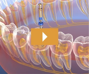 Root Canal Therapy Hershey PA